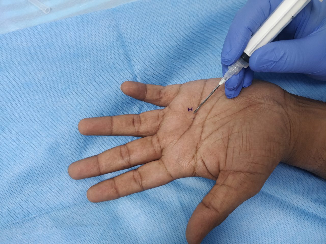 Trigger finger| FAQ | Shri Bone & Joint Clinic