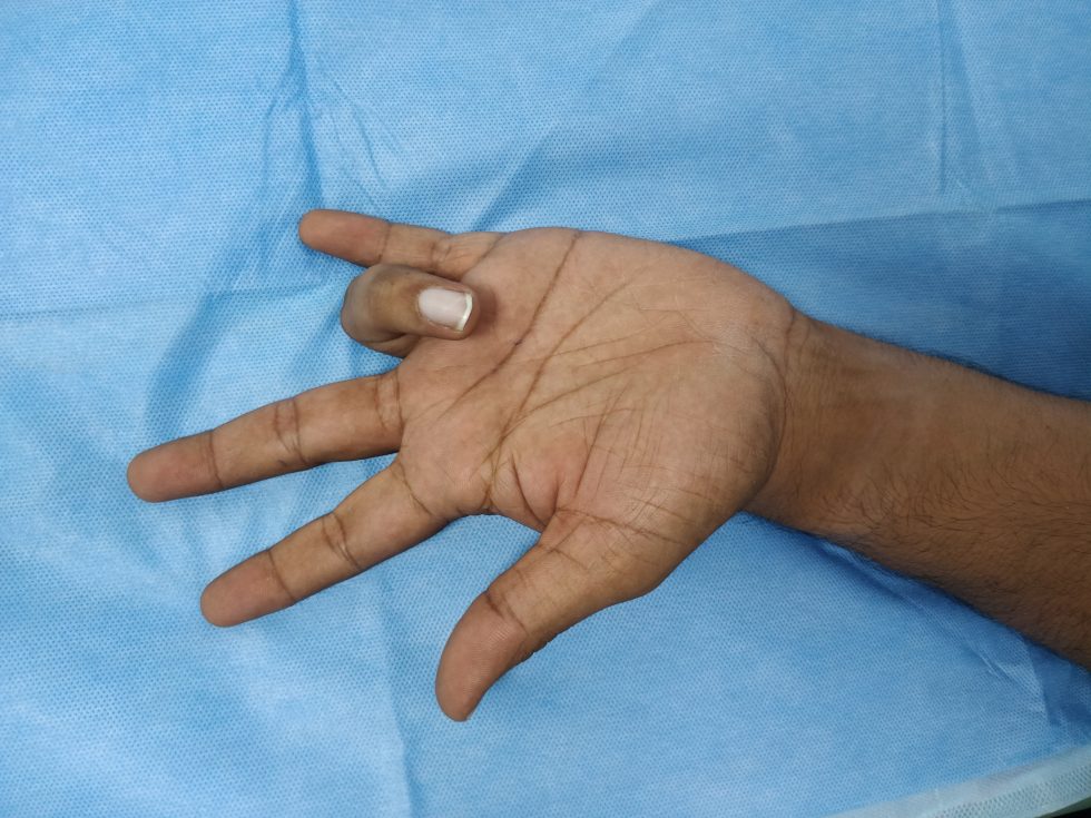 Trigger finger| FAQ | Shri Bone & Joint Clinic